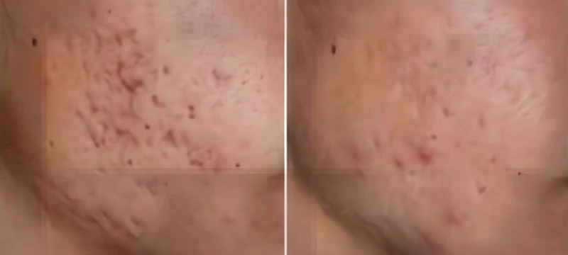 Best Fractional Co2 Laser Machine - Omni Laser Skinology