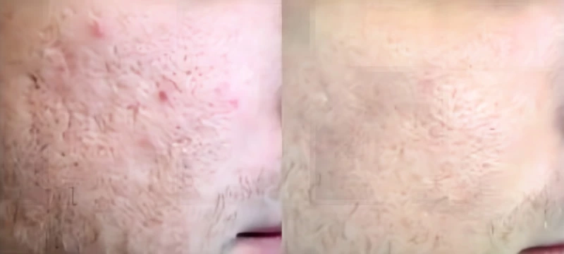 Best Fractional Co2 Laser Machine - Omni Laser Skinology